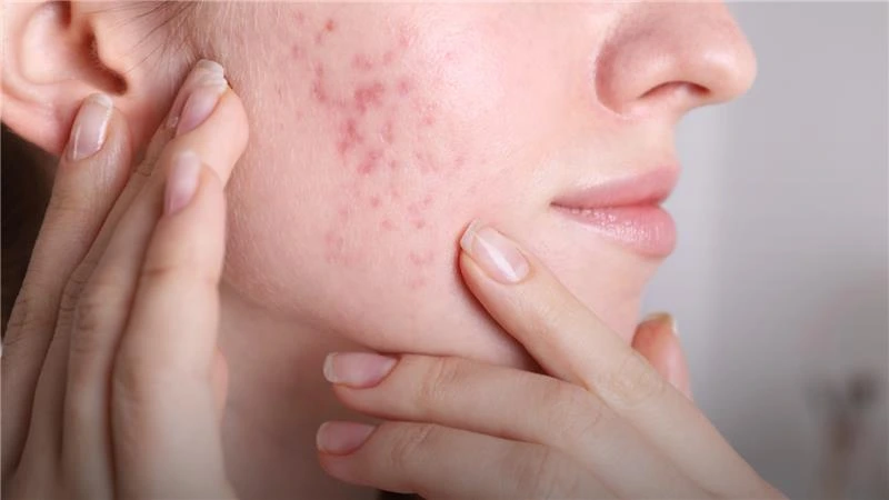 Are Dermal Fillers the Key to Smooth, Scar-Free Skin? An In-Depth Look