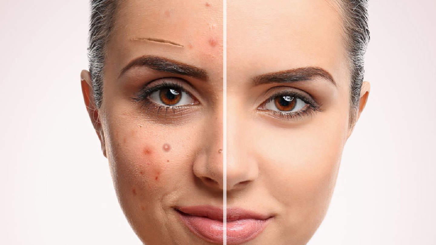 Scars Removal Treatment in Indore